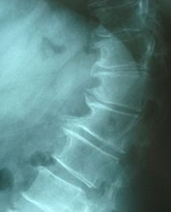 Spondylosis – Symptoms, Treatment, Complications and Diagnosis – Earth ...
